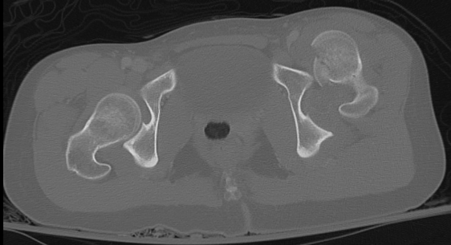 Femoral Head Fractures - Trauma - Orthobullets