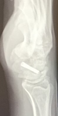 Scaphoid Fracture - Hand - Orthobullets