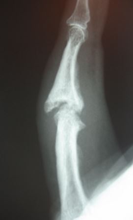 DIP and PIP Joint Arthritis - Hand - Orthobullets