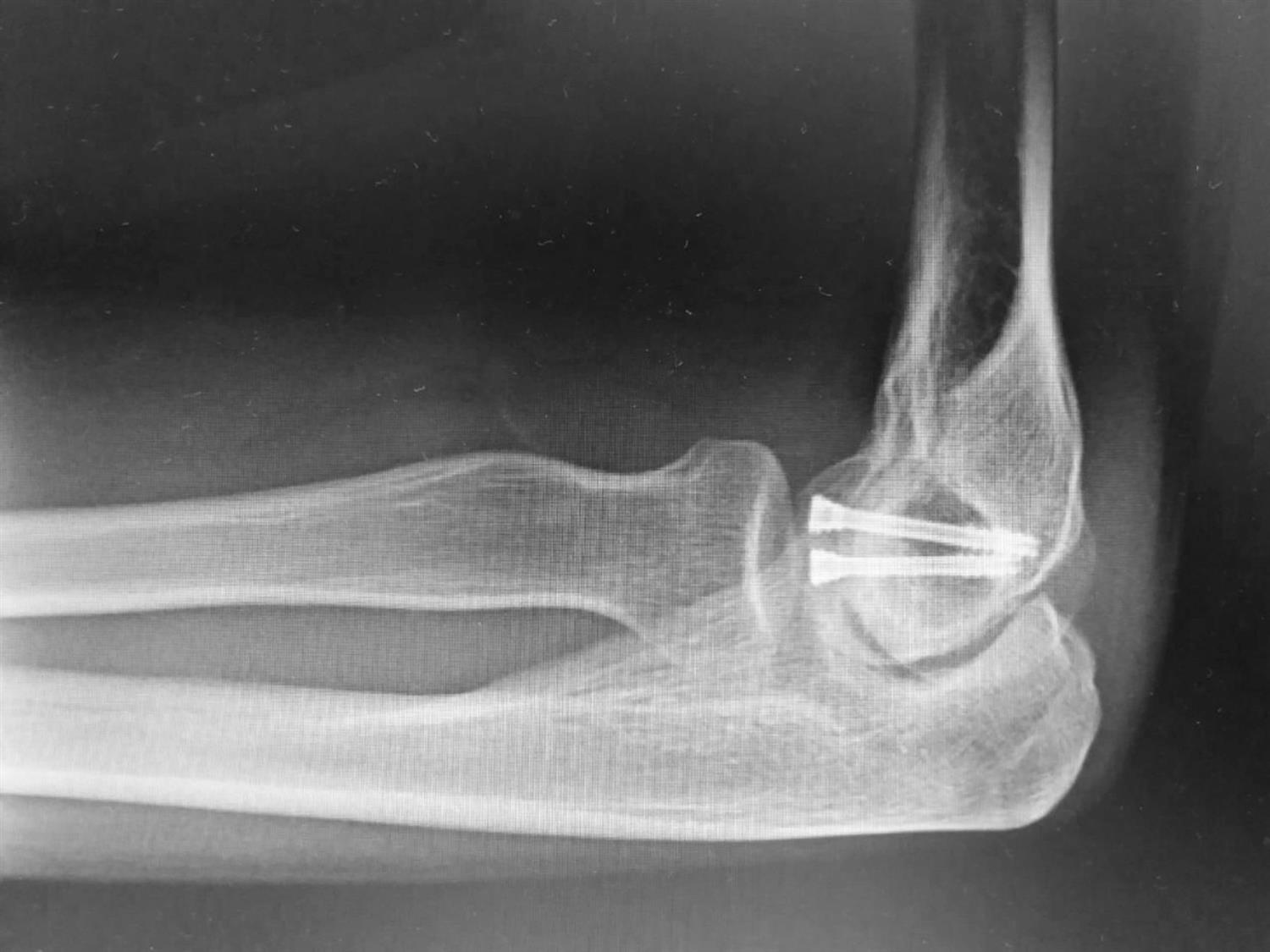 Question 211584 - Qbank - Orthobullets