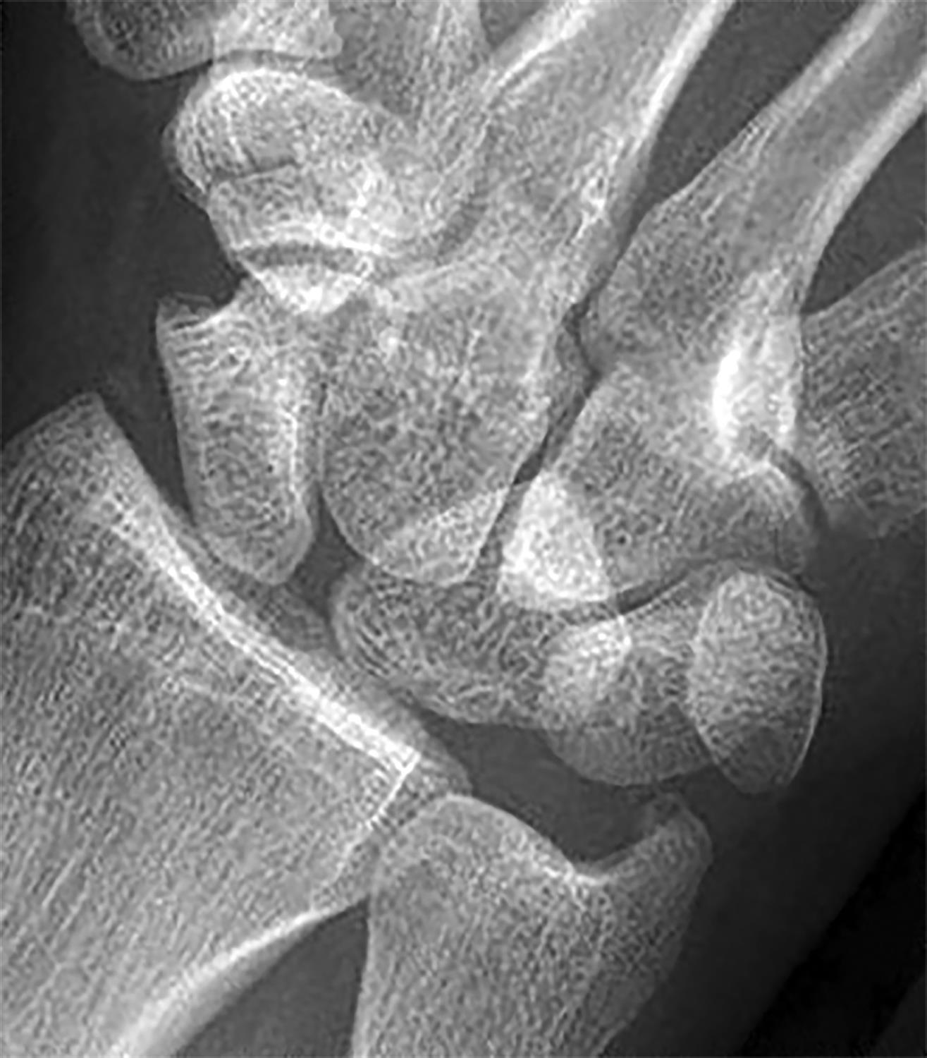 Lunate Dislocation (Perilunate dissociation) - Hand - Orthobullets