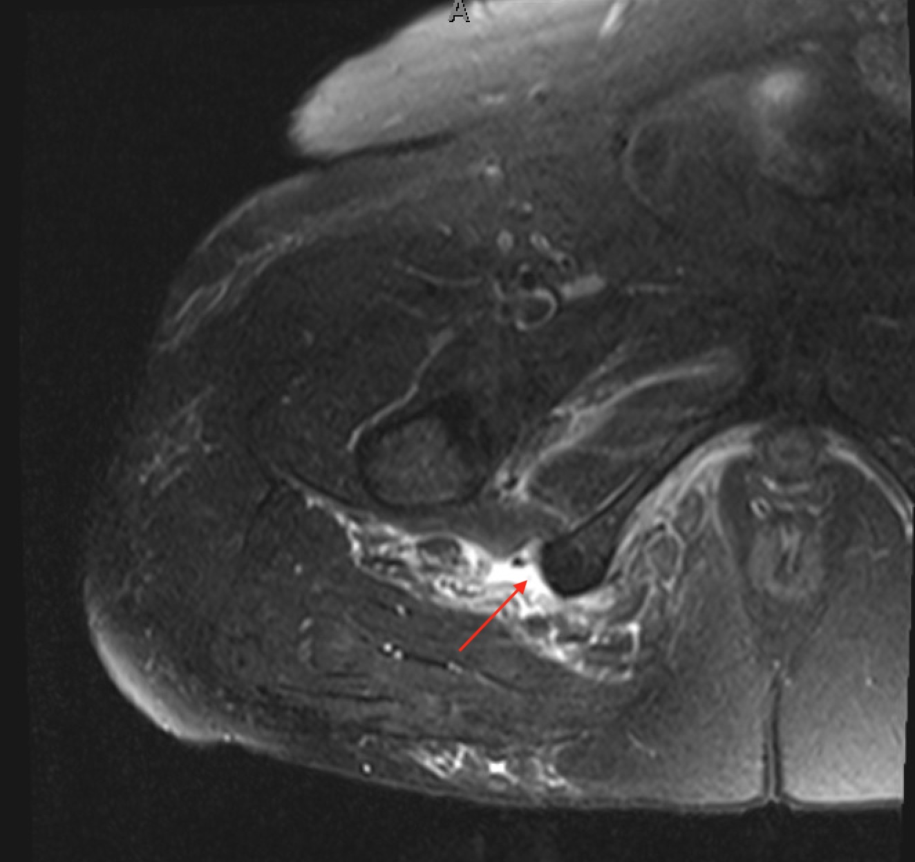 Question 212008 - Qbank - Orthobullets