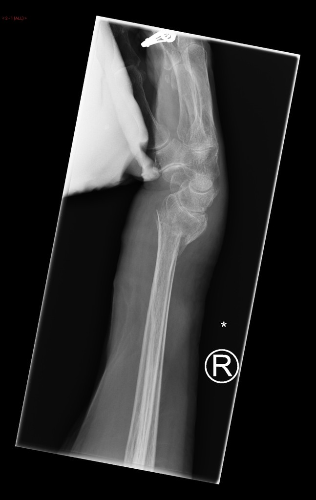 Distal Radial Ulnar Joint (DRUJ) Injuries - Trauma - Orthobullets