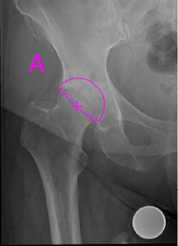 THA Templating - Recon - Orthobullets