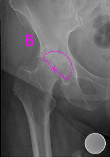 THA Templating - Recon - Orthobullets