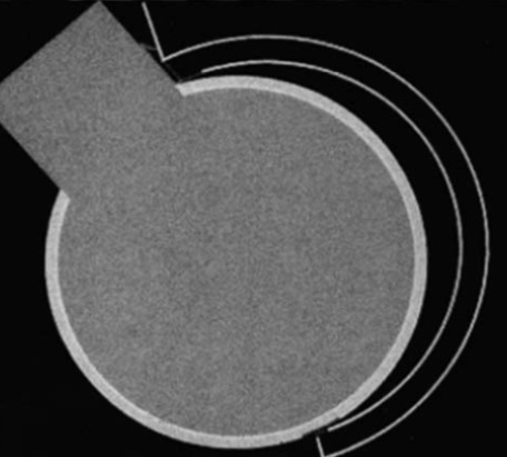 Question 212914 - Qbank - Orthobullets