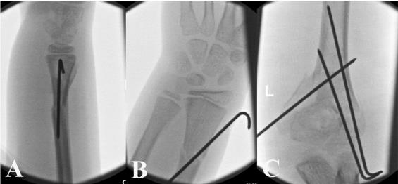 Question 212916 - Qbank - Orthobullets