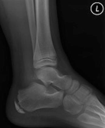 Foot Puncture Wounds - Foot & Ankle - Orthobullets