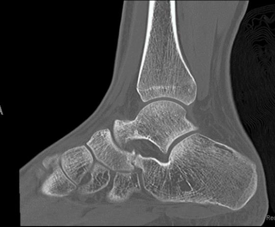Fibular Deficiency (anteromedial bowing) - Pediatrics - Orthobullets