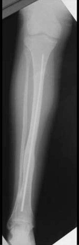 Question 212945 - Qbank - Orthobullets