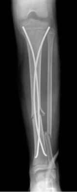 Question 212970 - Qbank - Orthobullets