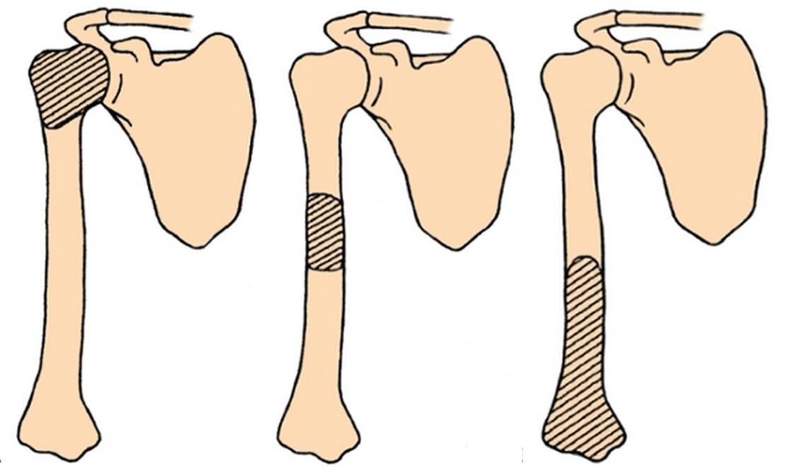 Question 212984 - Qbank - Orthobullets