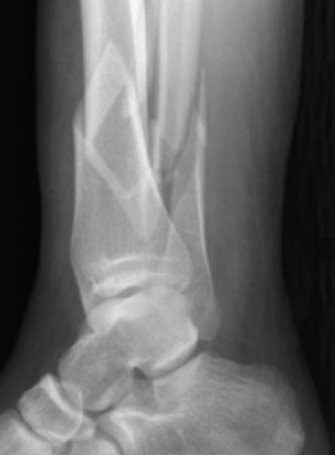 Complex Regional Pain Syndrome (CRPS) - Basic Science - Orthobullets