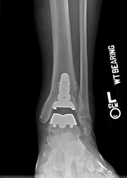 Total Ankle Arthroplasty - Foot & Ankle - Orthobullets