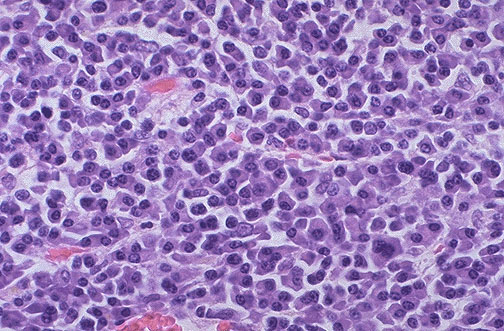 Multiple Myeloma - Pathology - Orthobullets