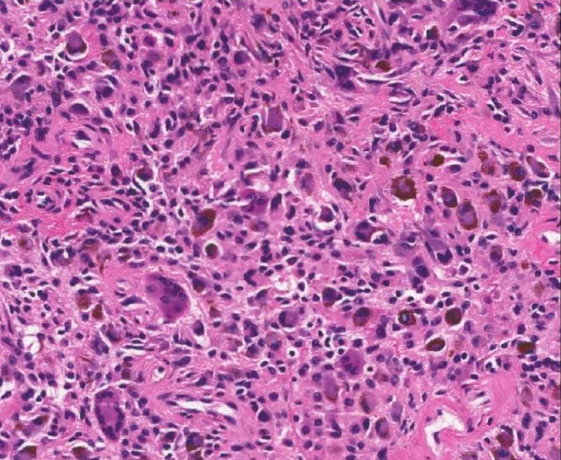 Giant Cell Tumor of Tendon Sheath - Hand - Orthobullets