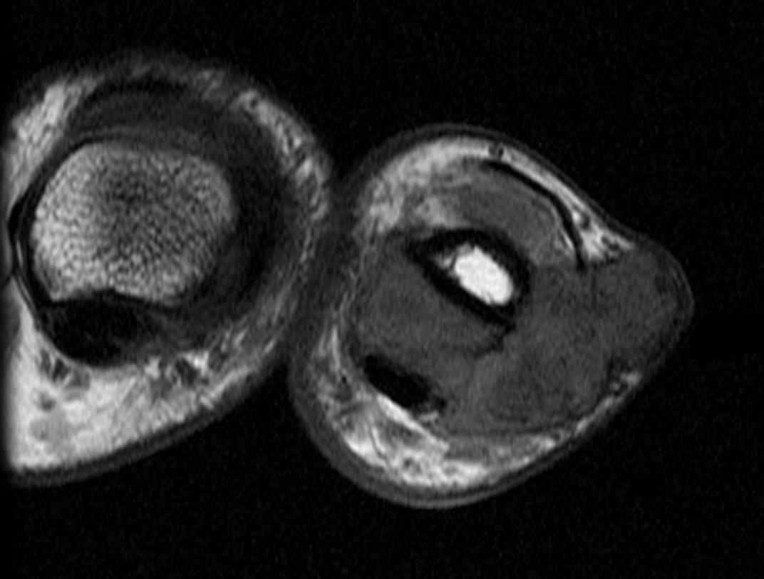 Giant Cell Tumor of Tendon Sheath - Hand - Orthobullets