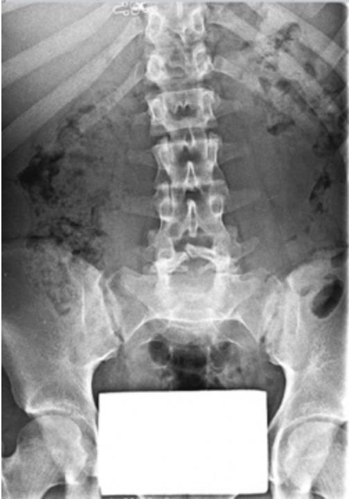 Adult Isthmic Spondylolisthesis - Spine - Orthobullets