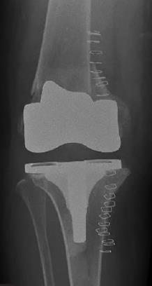 TKA Periprosthetic Fracture - Recon - Orthobullets