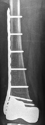 Question 213118 - Qbank - Orthobullets