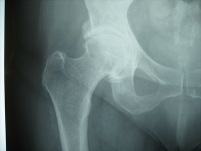Hip Osteoarthritis - Recon - Orthobullets
