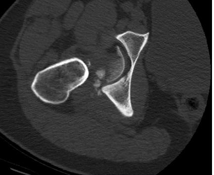 Femoral Head Fractures - Trauma - Orthobullets