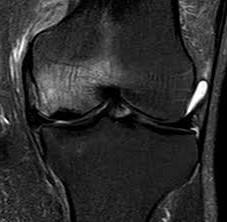 Spontaneous Osteonecrosis of the Knee (SONK) - Knee & Sports - Orthobullets