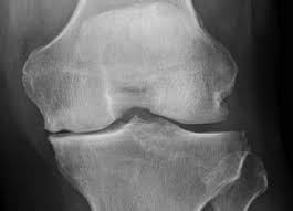 Spontaneous Osteonecrosis of the Knee (SONK) - Knee & Sports - Orthobullets