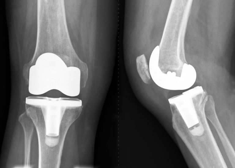 Is Adductor Canal Block Better Than Femoral Nerve Block in Primary ...