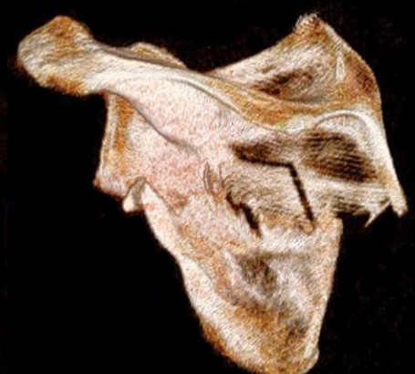 Scapula Fractures - Trauma - Orthobullets