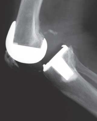 Question 214242 - Qbank - Orthobullets