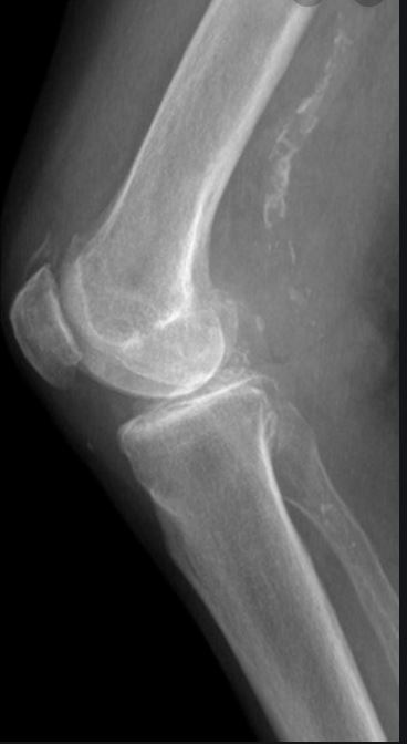 TKA Vascular Injury and Bleeding - Recon - Orthobullets