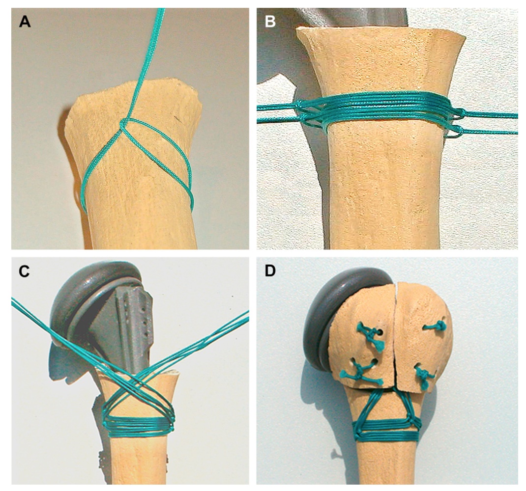 Question 214827 - Qbank - Orthobullets