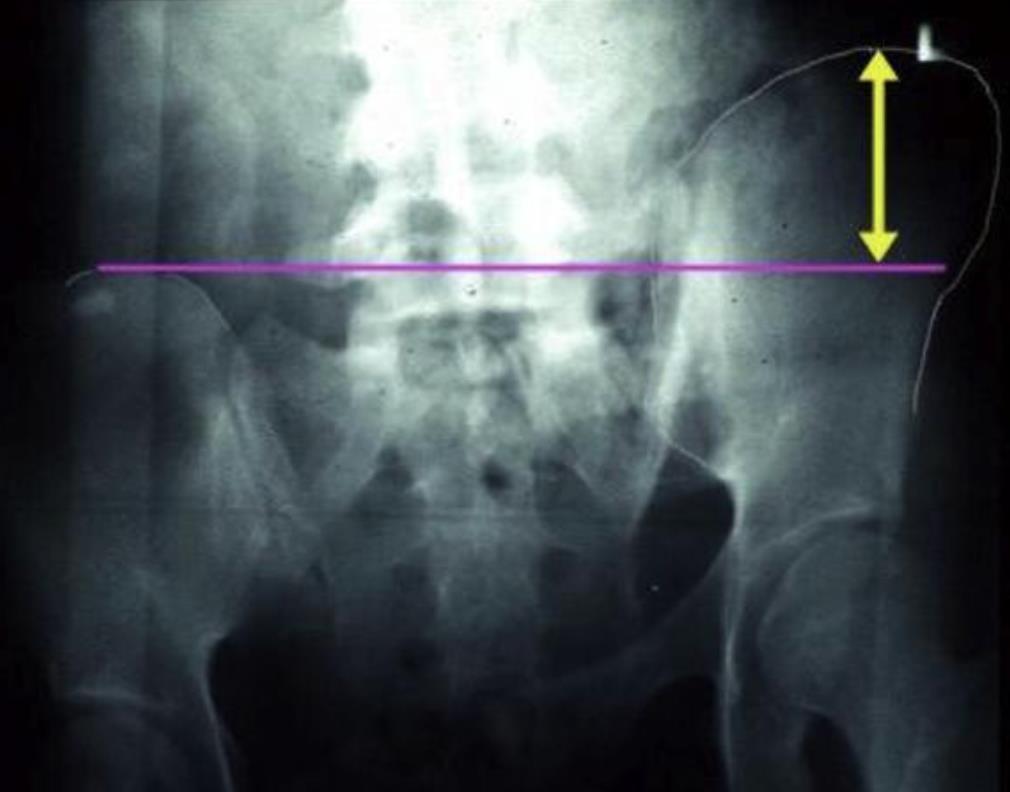 Question 215530 - Qbank - Orthobullets