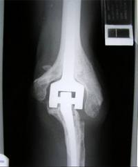 Question 216807 - Qbank - Orthobullets