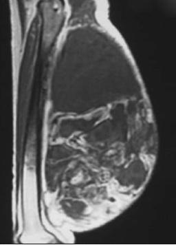 Liposarcoma - Pathology - Orthobullets