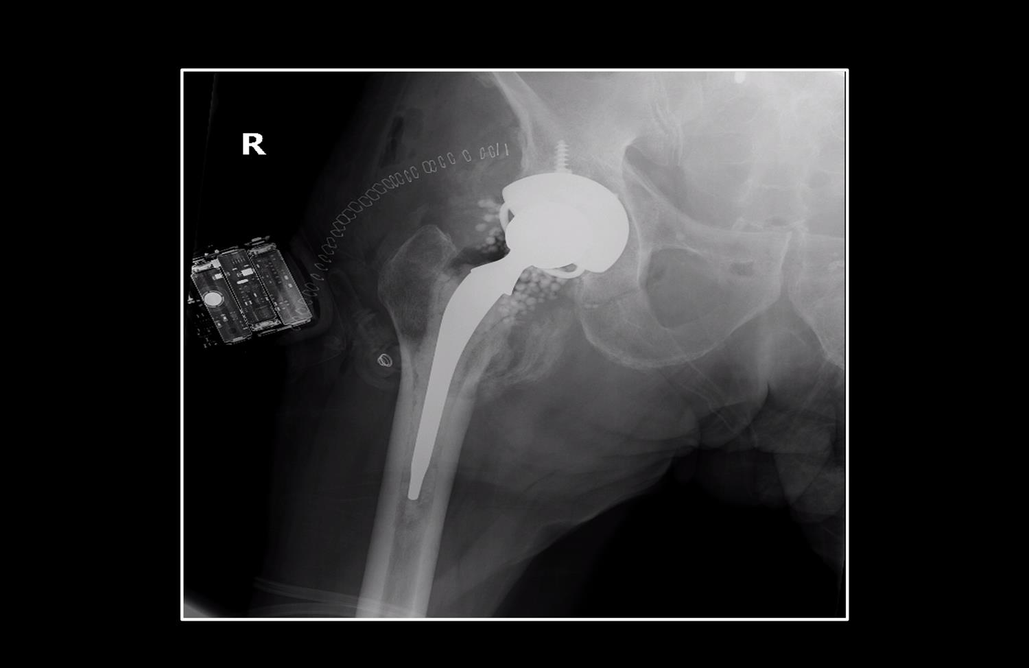 Question 218092 - Qbank - Orthobullets