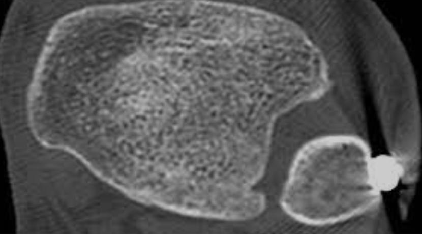 Question 218543 - Qbank - Orthobullets