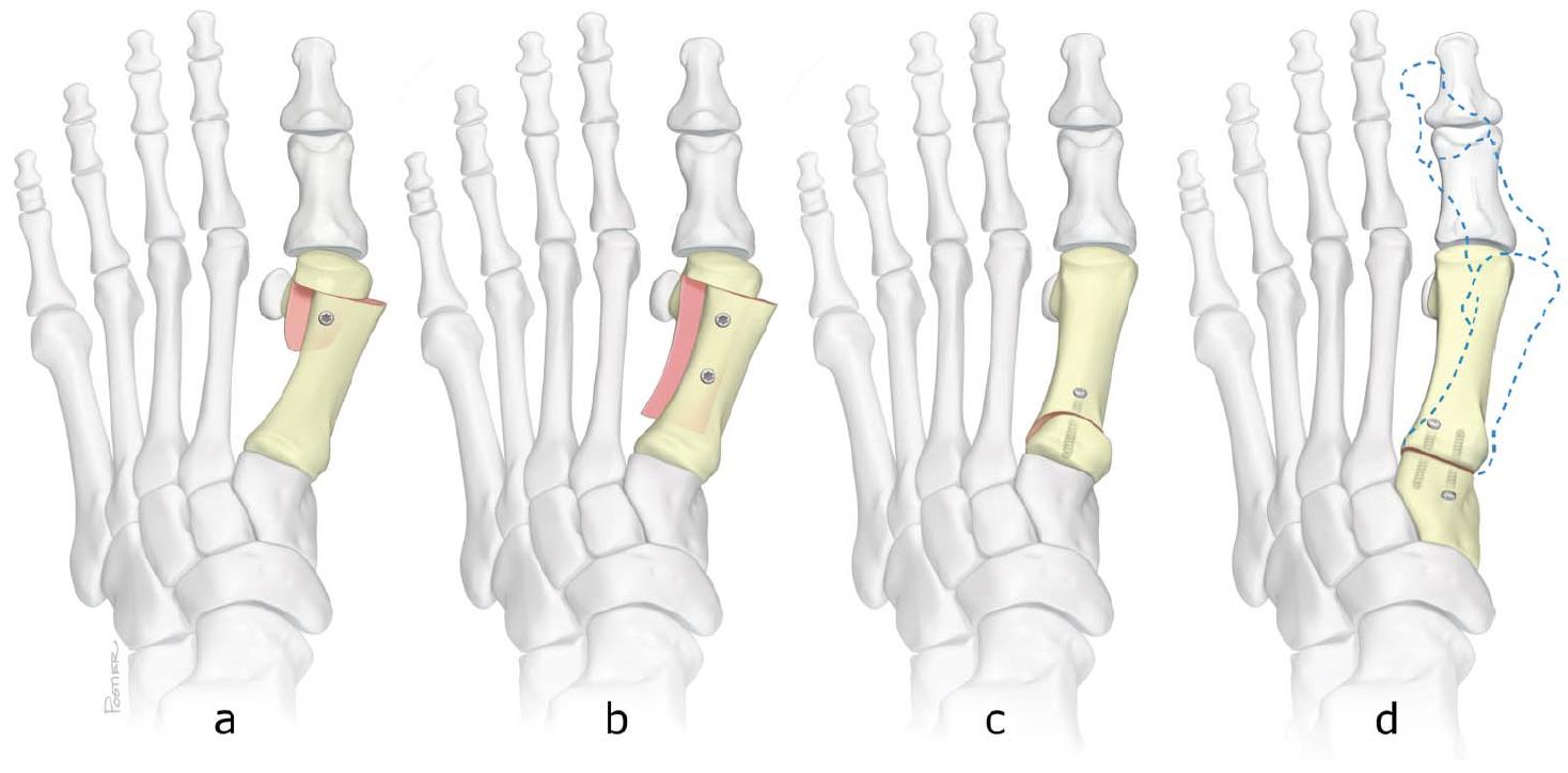 Question 218645 - Qbank - Orthobullets