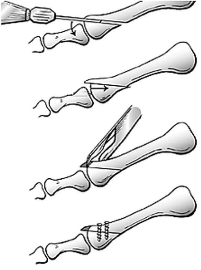 Question 218649 - Qbank - Orthobullets