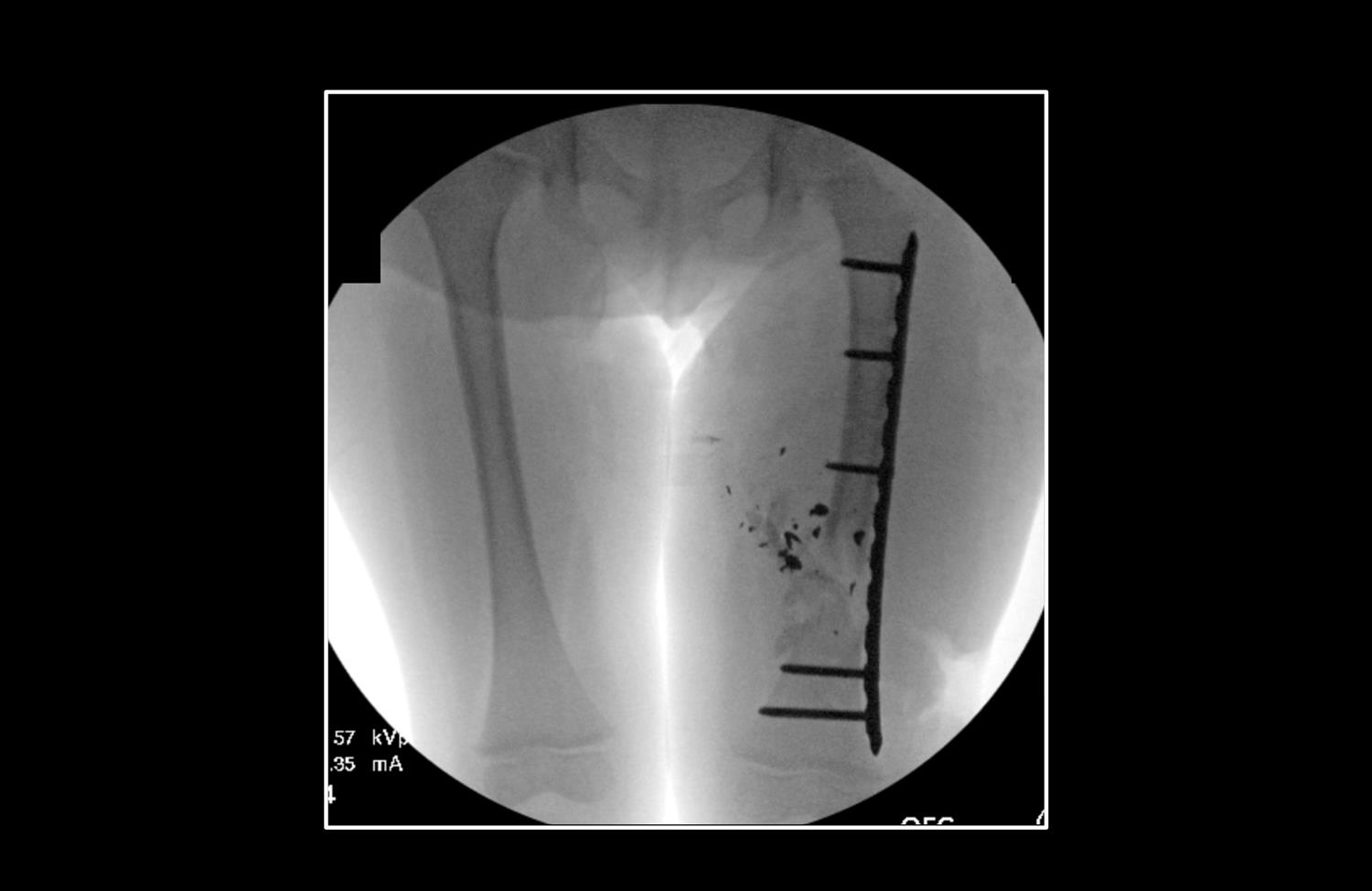 Question 218706 - Qbank - Orthobullets