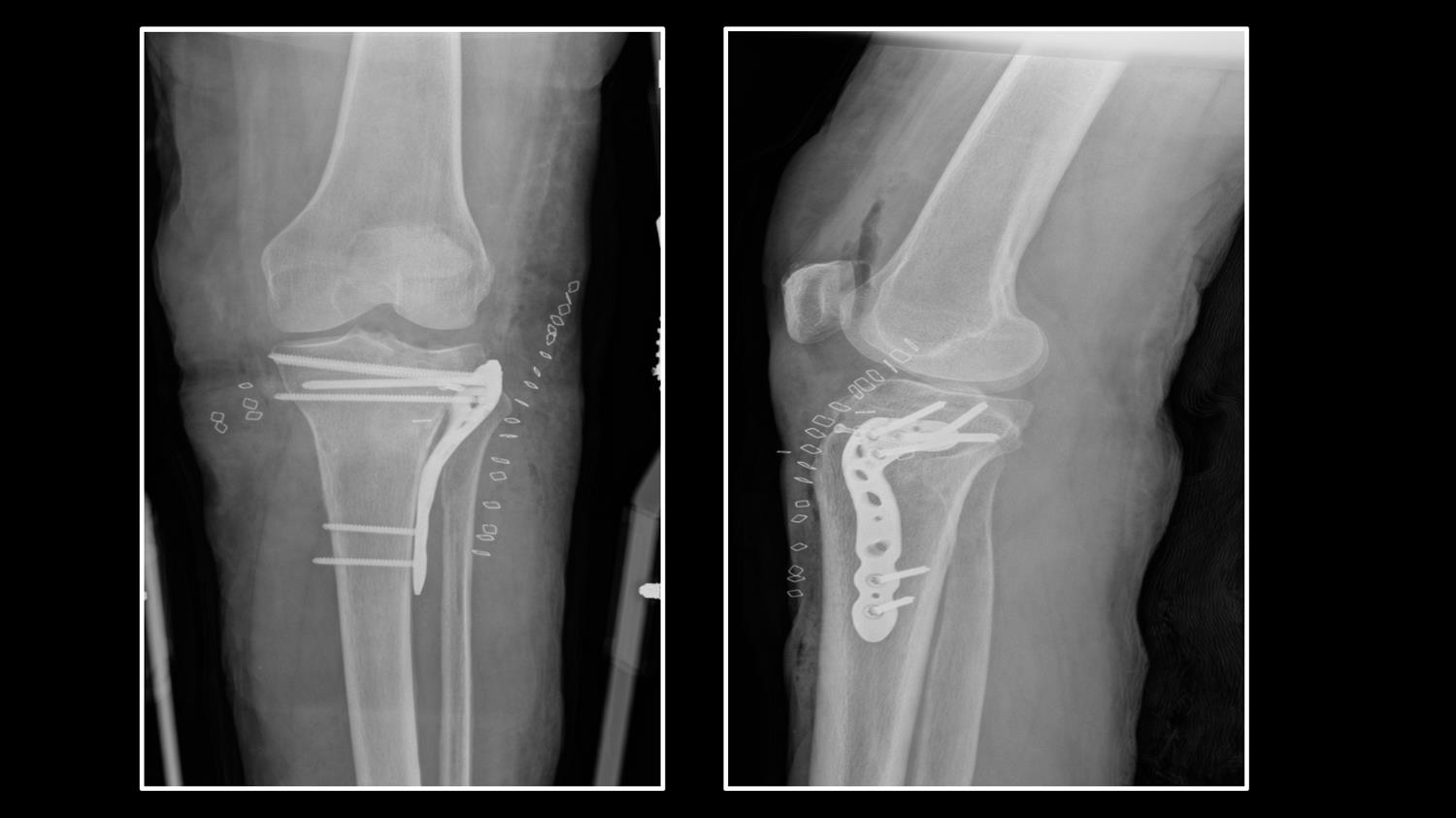 Question 218946 - Qbank - Orthobullets