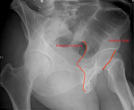 Question 219155 - Qbank - Orthobullets