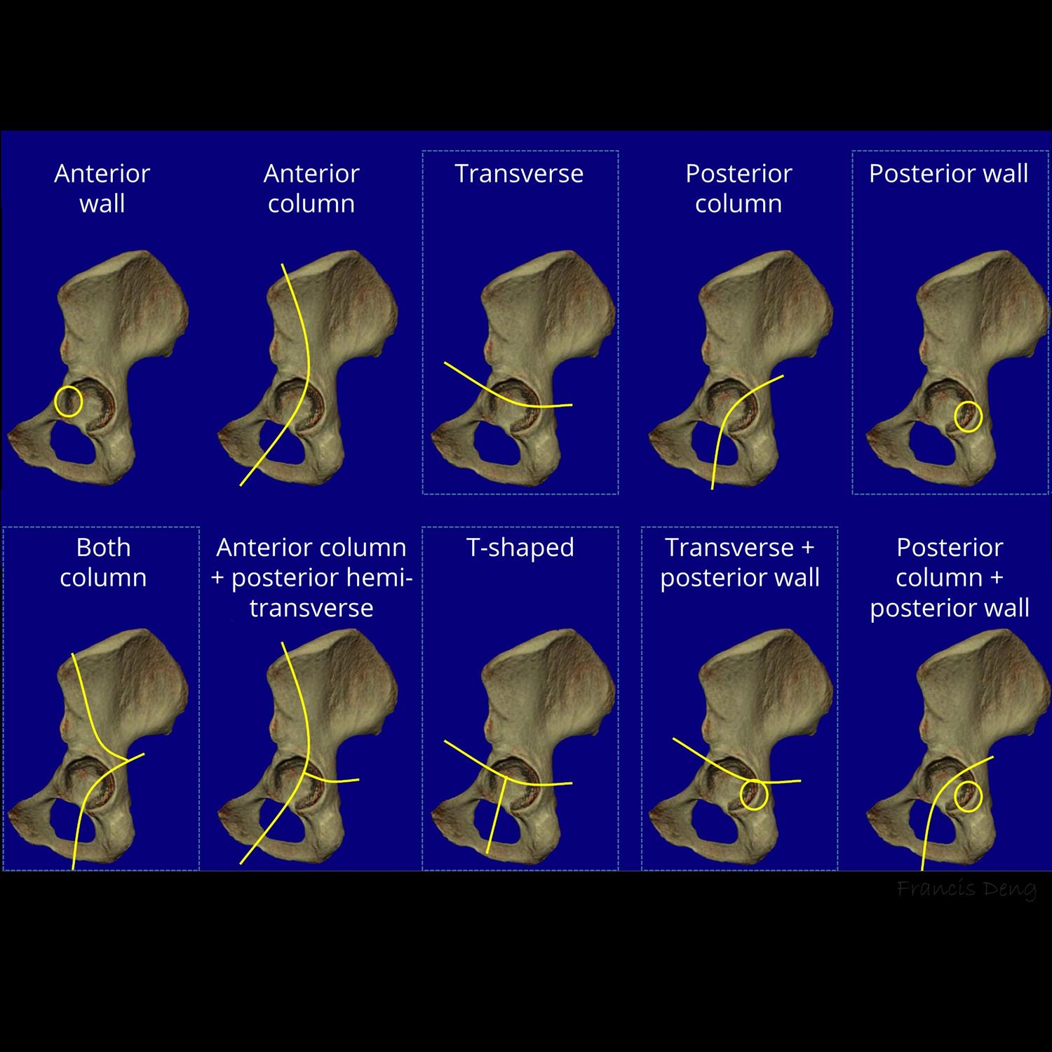 Question 219155 - Qbank - Orthobullets