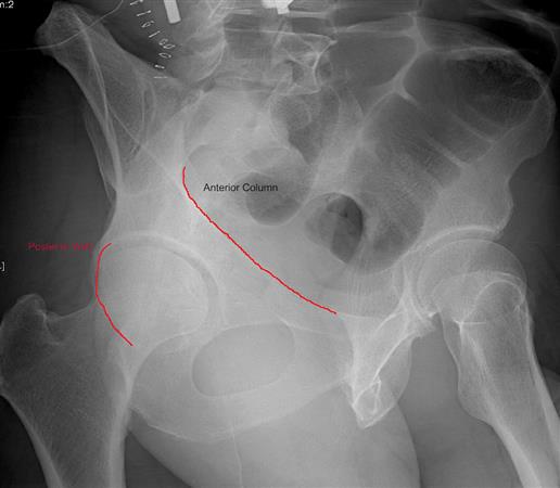 Question 219155 - Qbank - Orthobullets
