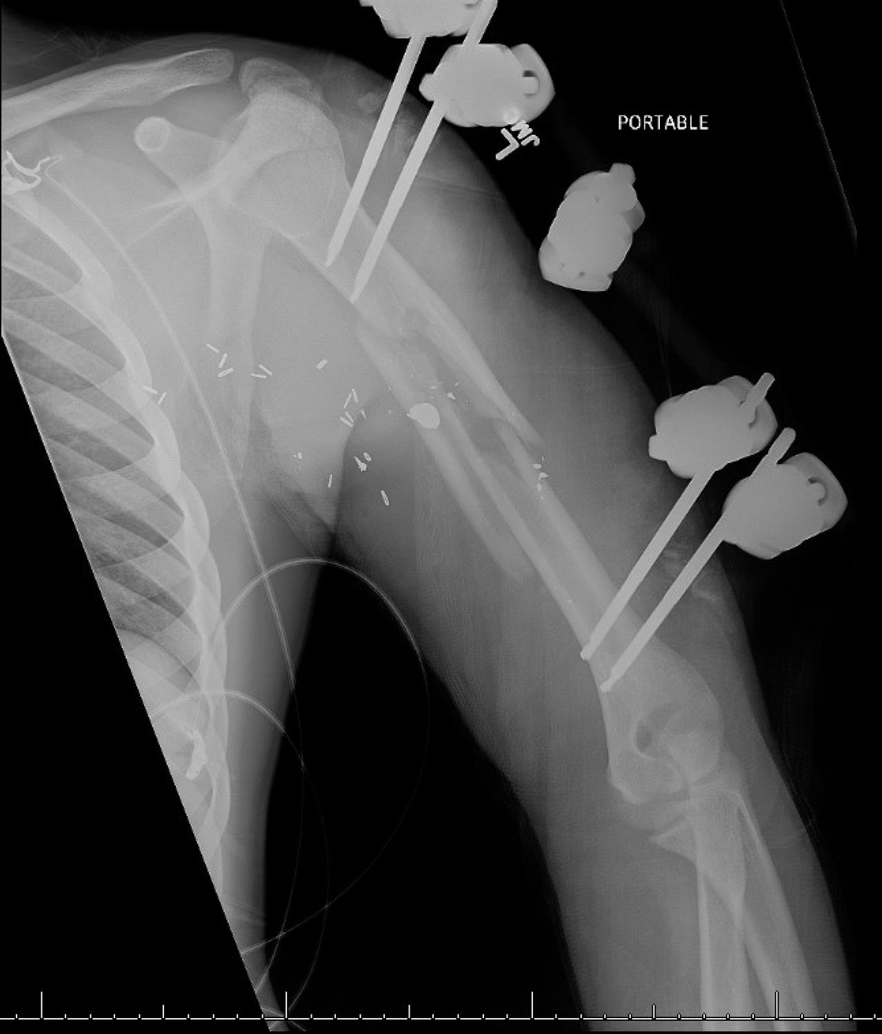 Question 219161 - Qbank - Orthobullets