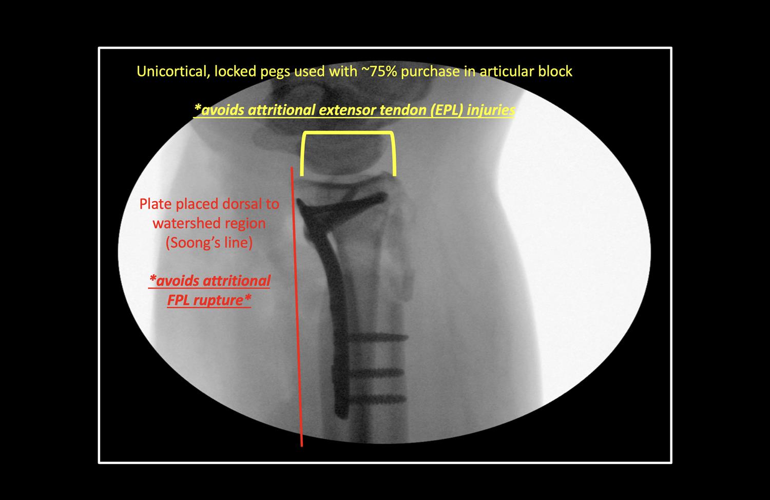 Question 219176 - Qbank - Orthobullets