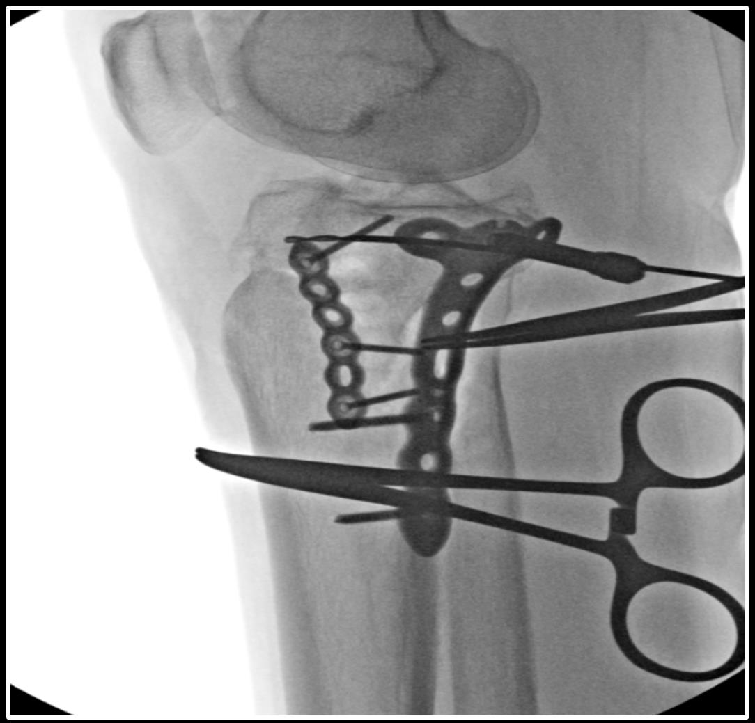 Question 219177 - Qbank - Orthobullets