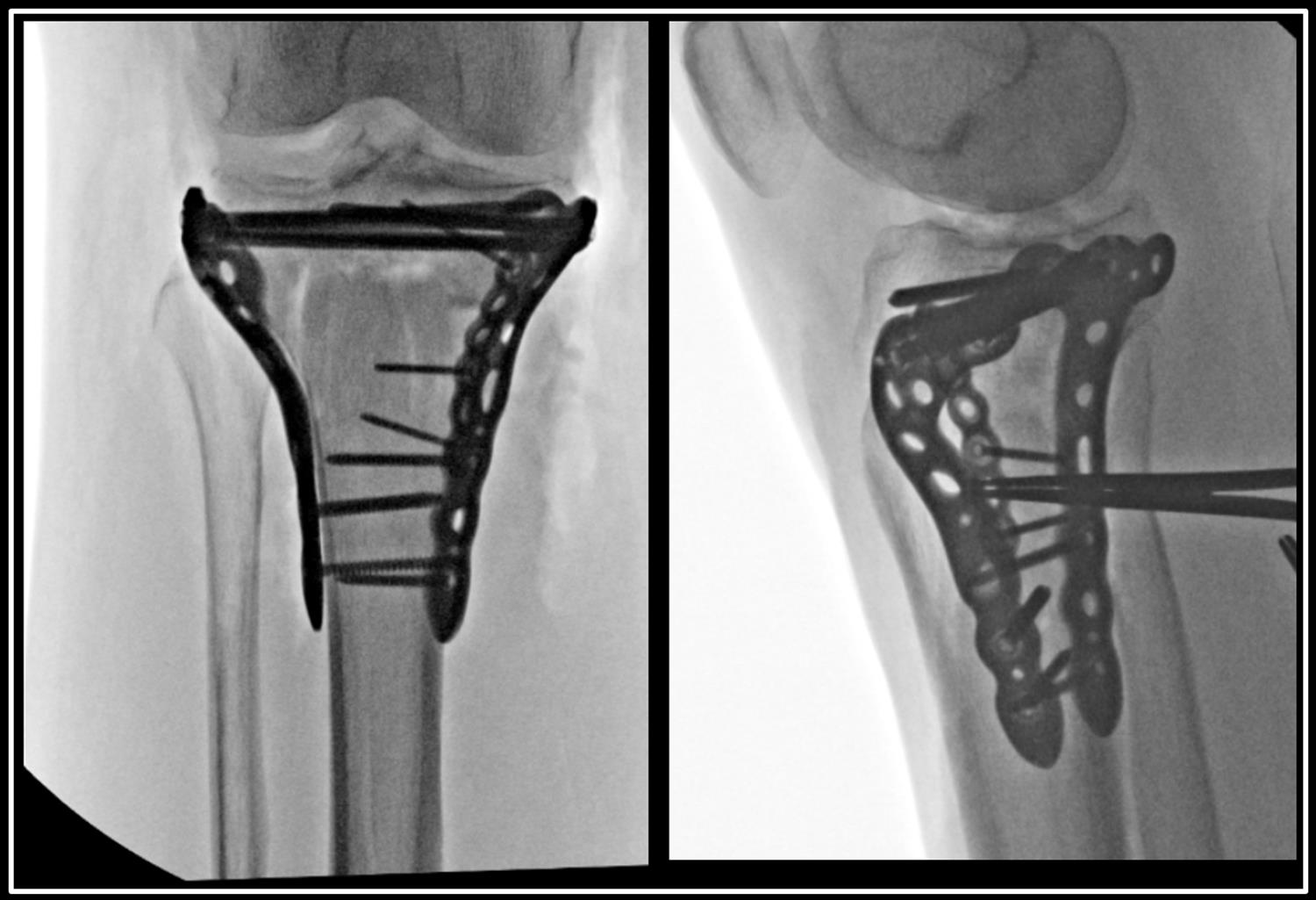 Question 219177 - Qbank - Orthobullets