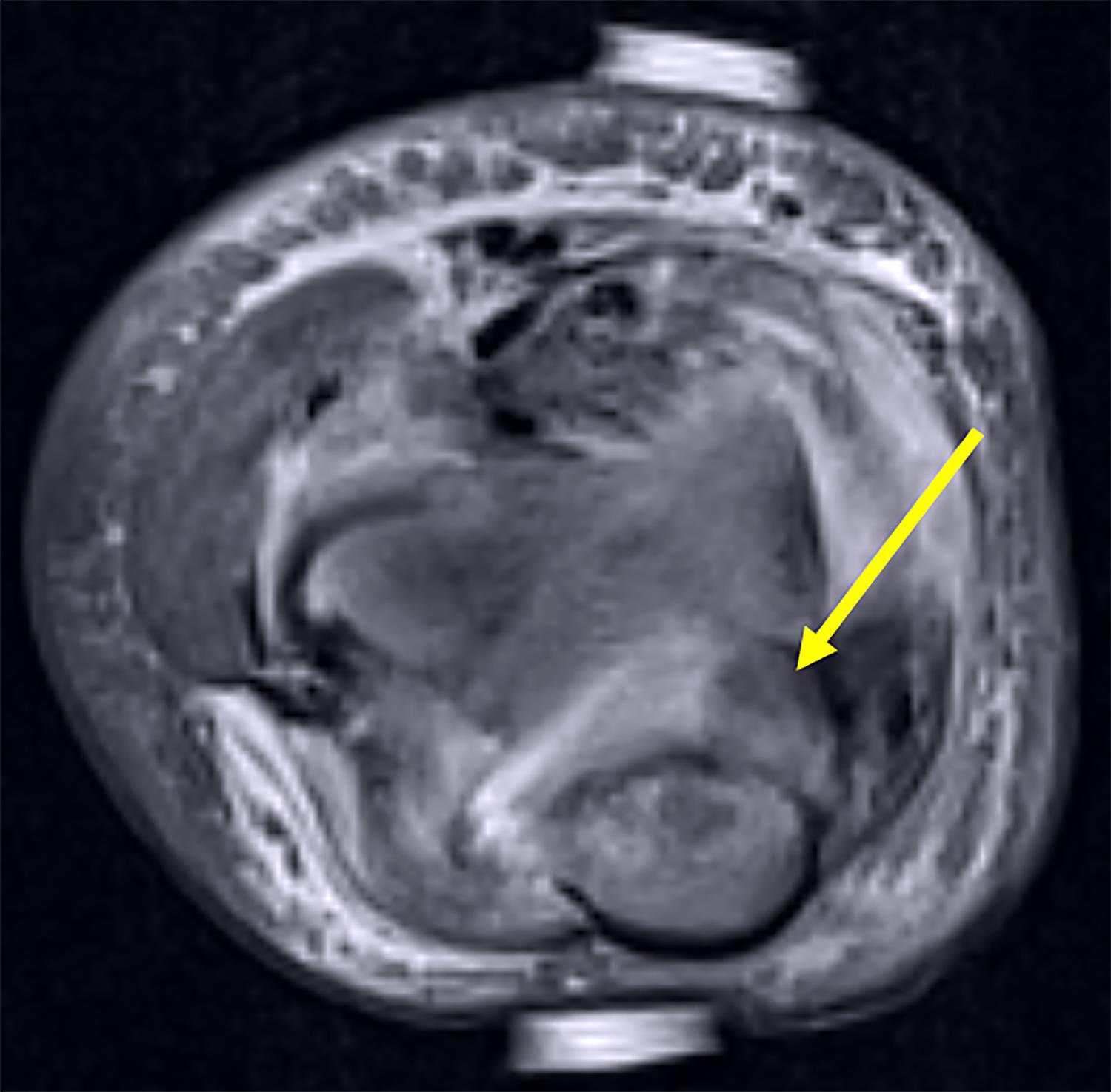 Question 219366 - Qbank - Orthobullets